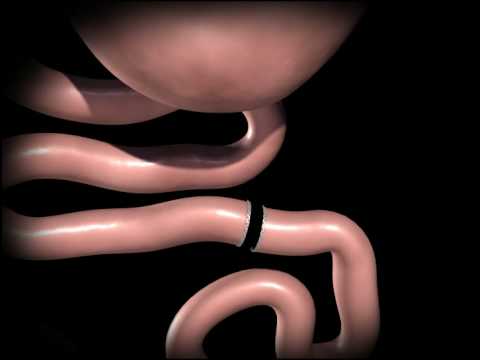 Roux-en-Y Gastric Bypass