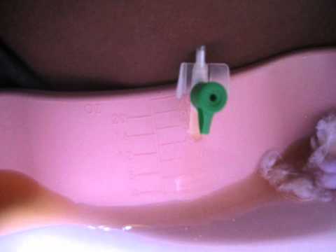 Drainage of Ascites using abdominal paracentesis.