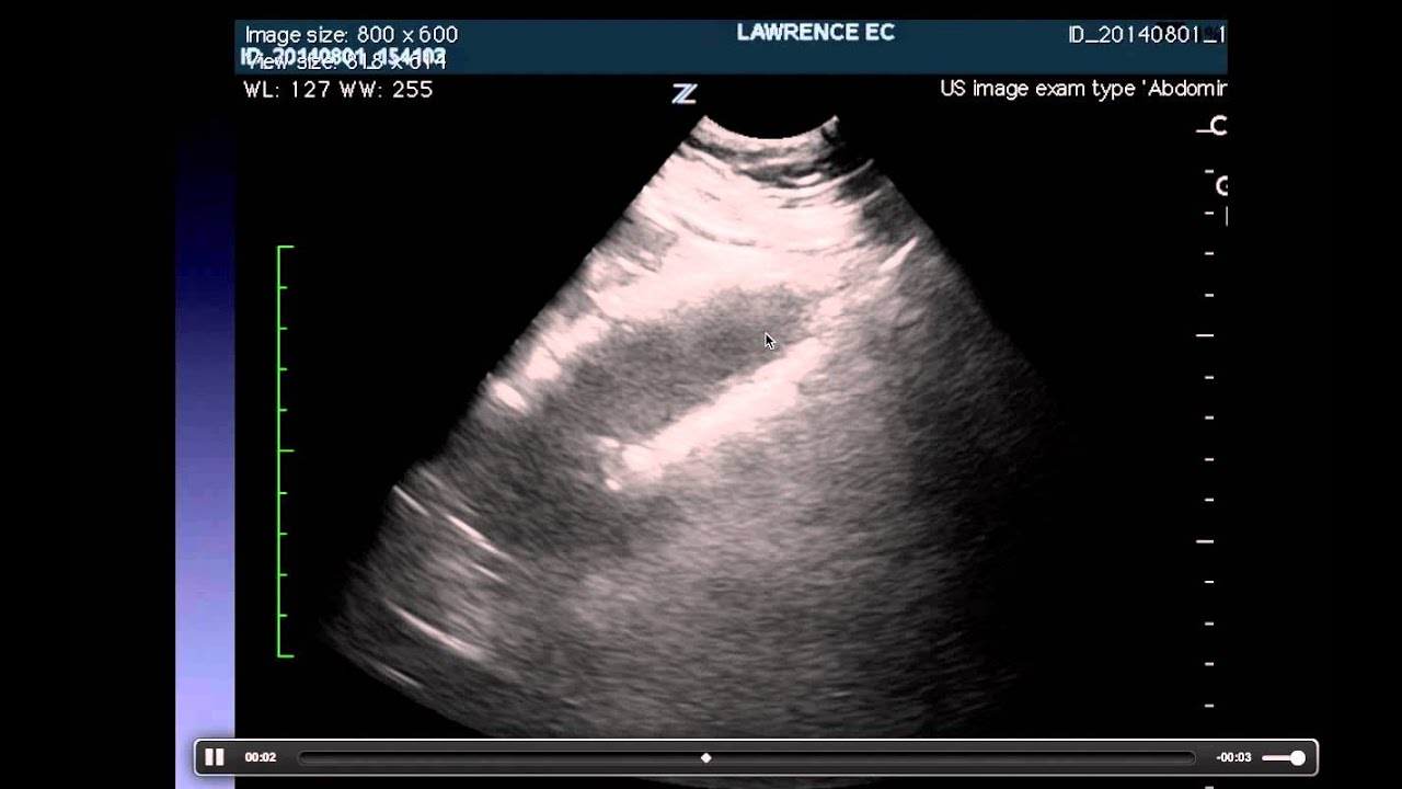 A-lines in the gallbladder?