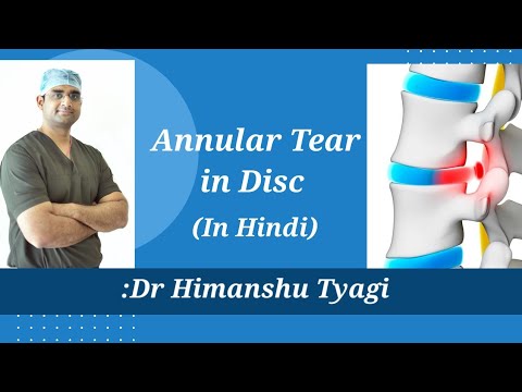 Annular tear in Disc