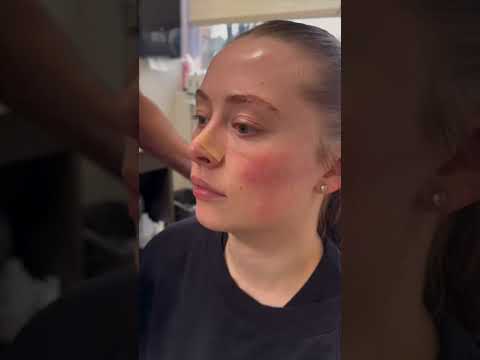 How to Tape Your Nose After Rhinoplasty