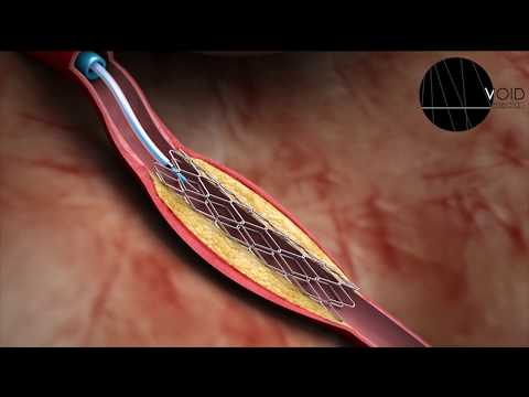 VOID Cleveland Clinic AD PCI Medical Animation