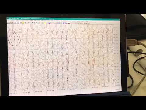 Portable EEG Machine - Second Hand EEG Machine Latest Price ...