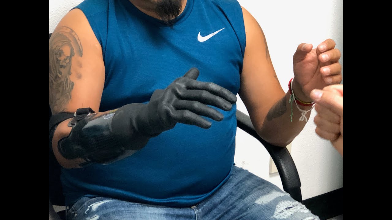 Ossur i-Limb® Prosthetic Demonstration