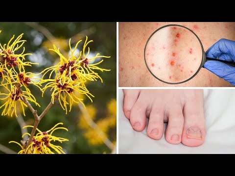 Health Benefits of Witch Hazel | Healthy Living Tips