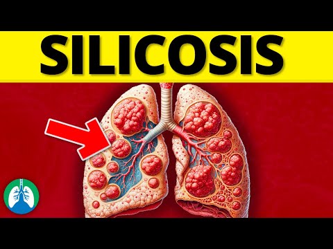 What is Silicosis? (EXPLAINED)