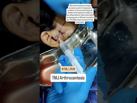 TMJ Arthrocentesis For TMJ Pain Relief | Dr Parit Ladani