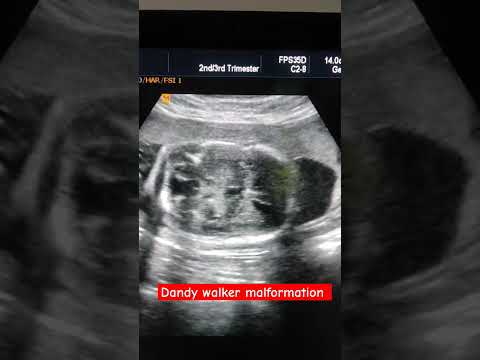 Dandy Walker malformation