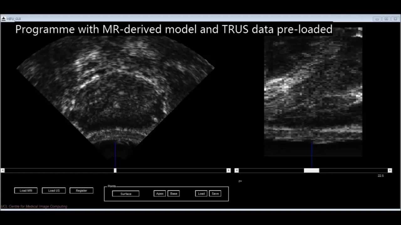 A novel deformable MR-US registration system