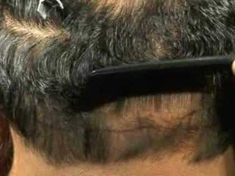 Forhair-1300 CIT with video of donor area | Video by Dr. Cole