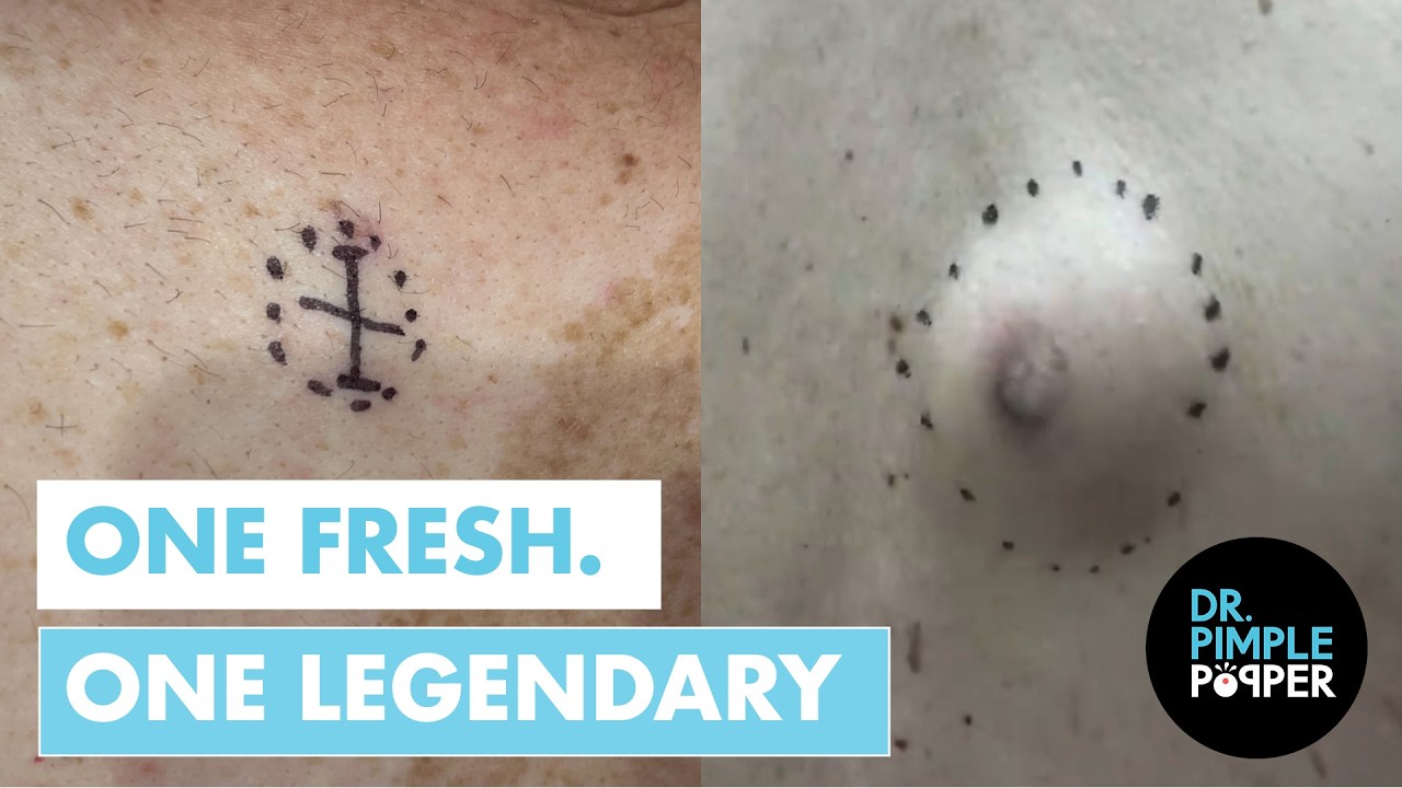 One Fresh Back Cyst and One YouTube Legend | Dr. Pimple Popper