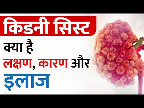किडनी सिस्ट क्या है? लक्षण, कारण और इलाज | Simple Renal Cysts | Kidney Cyst | Dr Puru Dhawan