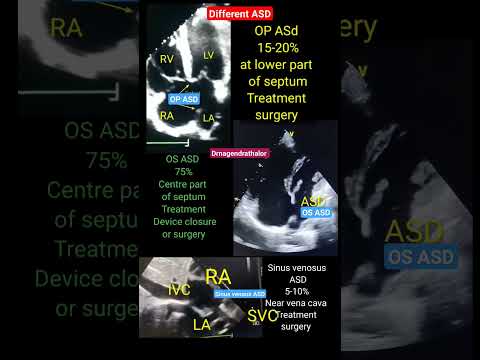 Different types of ASD ( Atrial septal defect) Echo #asd #echo #shorts