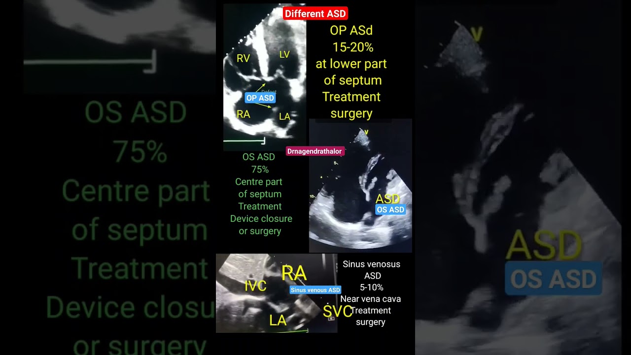 Different types of ASD ( Atrial septal defect) Echo #asd #echo #shorts