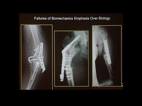 Mending the Injured: How are Fractures Treated?