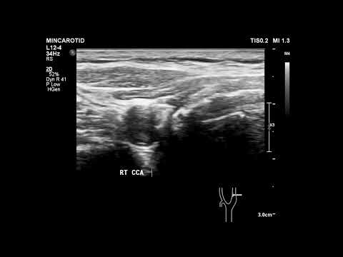 ICA(internal carotid artery) kinking