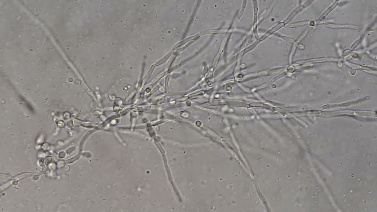 Pseudohyphae of Candida albicans in Urine