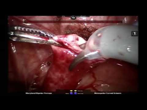 AUA2019 V07-01 Robot assisted laparoscopic extravesical cross-trigonal ureteral re-implantation