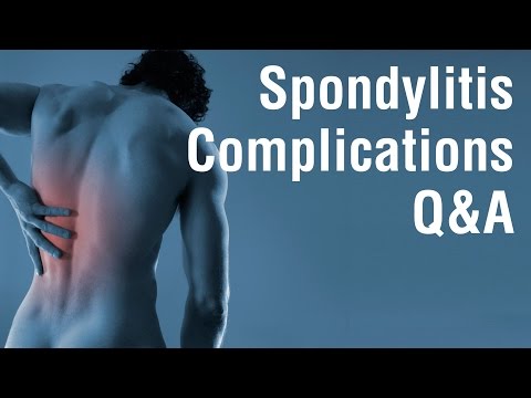 Troubleshooting Spondylitis Information Session