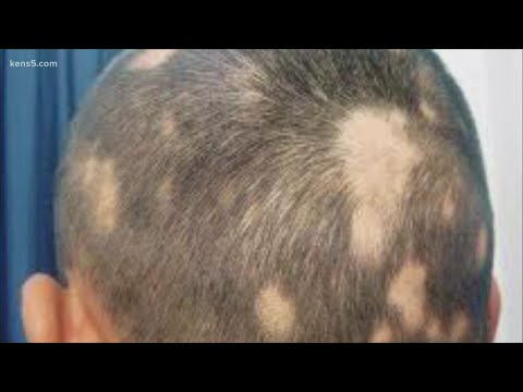 What is alopecia?