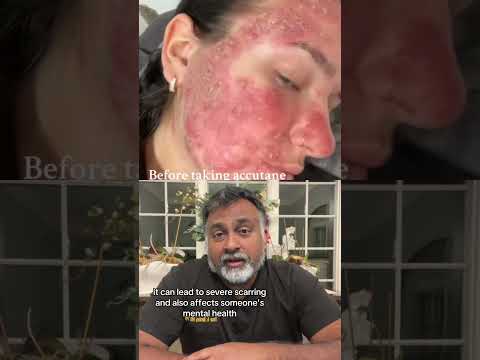 Accutane reaction from a board certified dermatologist #shorts