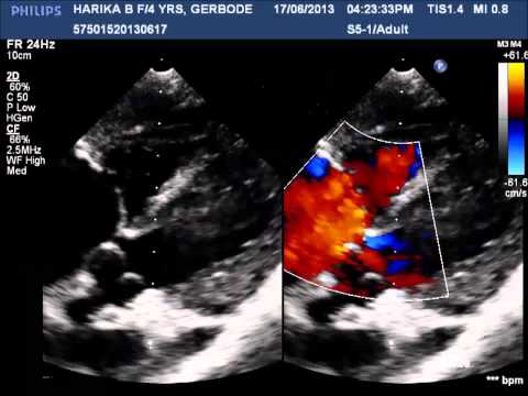 The Gerbode defect: the significance of a left ventricular to right ...