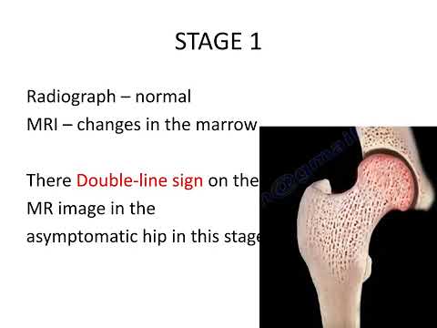 AVN OF FEMUR HEAD (Avascular necrosis) PPT