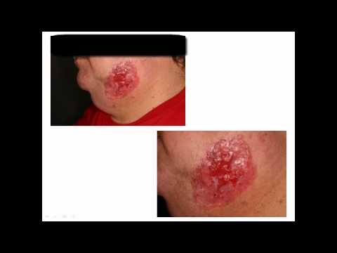 Internal Medicine Grand Rounds: New and Coming Dermatologic Therapies