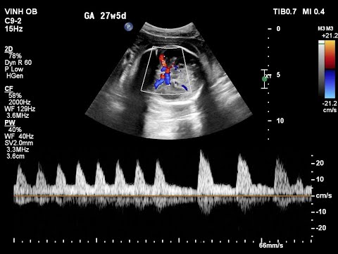 Fetal arrhythmia ( intermittent supraventricular tachycardia) complicates fetal ascite!!!
