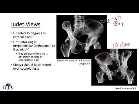 Acetabulum Fractures – OrthoClips