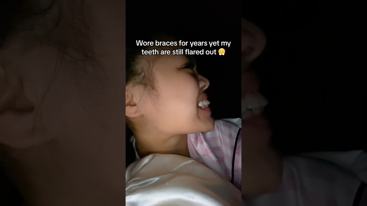 Flared Teeth? Here's WHY it happened and how to fix it!