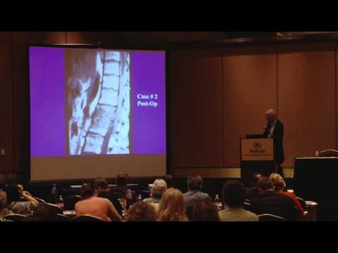 ASAP Chiari & Syringomyelia Conference Ulrich Batzdorf, MD "Spinal Syringomyelia"