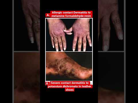 Allergic contact dermatitis to melamine formaldehyde resin : severe contact dermatitis to potassium