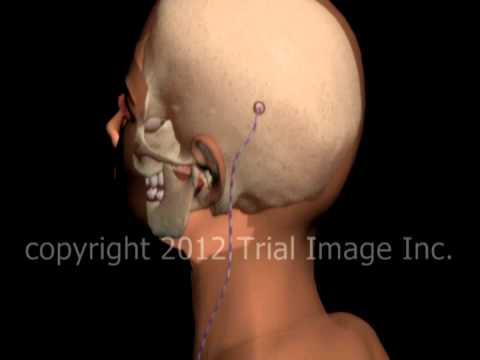 Hydrocephalus shunt video by Dr. Cal Shipley, M.D.