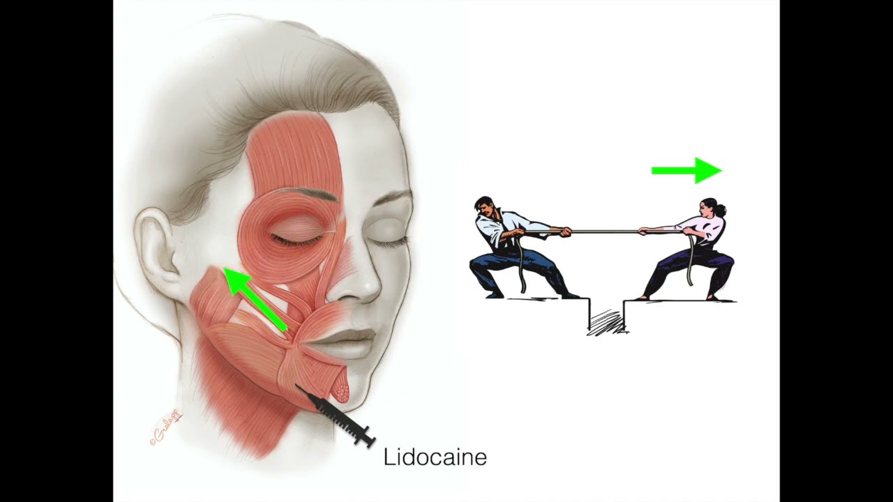 Lidocaine Injection to DAO
