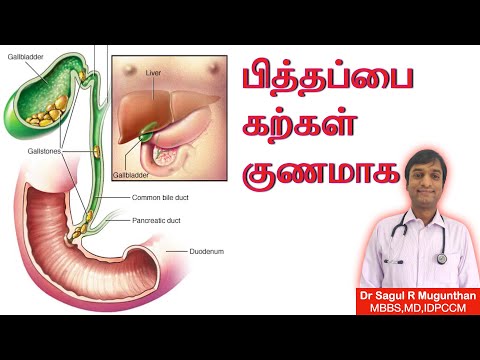 பித்தப்பை கல் அறிகுறிகள் & குணமாக வழிகள் | Gallbladder stones prevention in Tamil