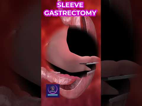 Sleeve Gastrectomy in Bariatric Surgery