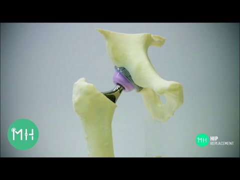 What is a hip replacement?