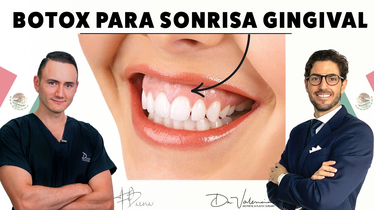Do you show too much gum when you smile? Quick and Reversible Solution | Gummy Smile Botox