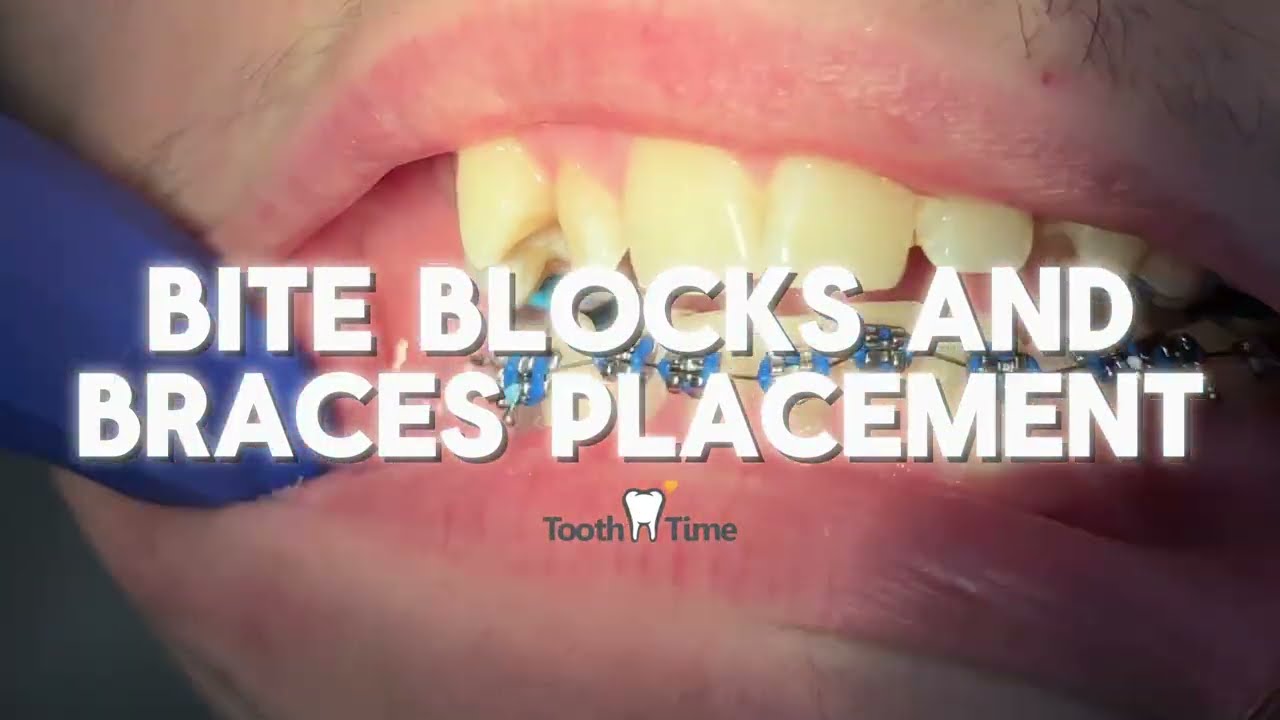 Why Do We Add Bite Blocks When We Put Braces On? Tooth Time Family Dentistry