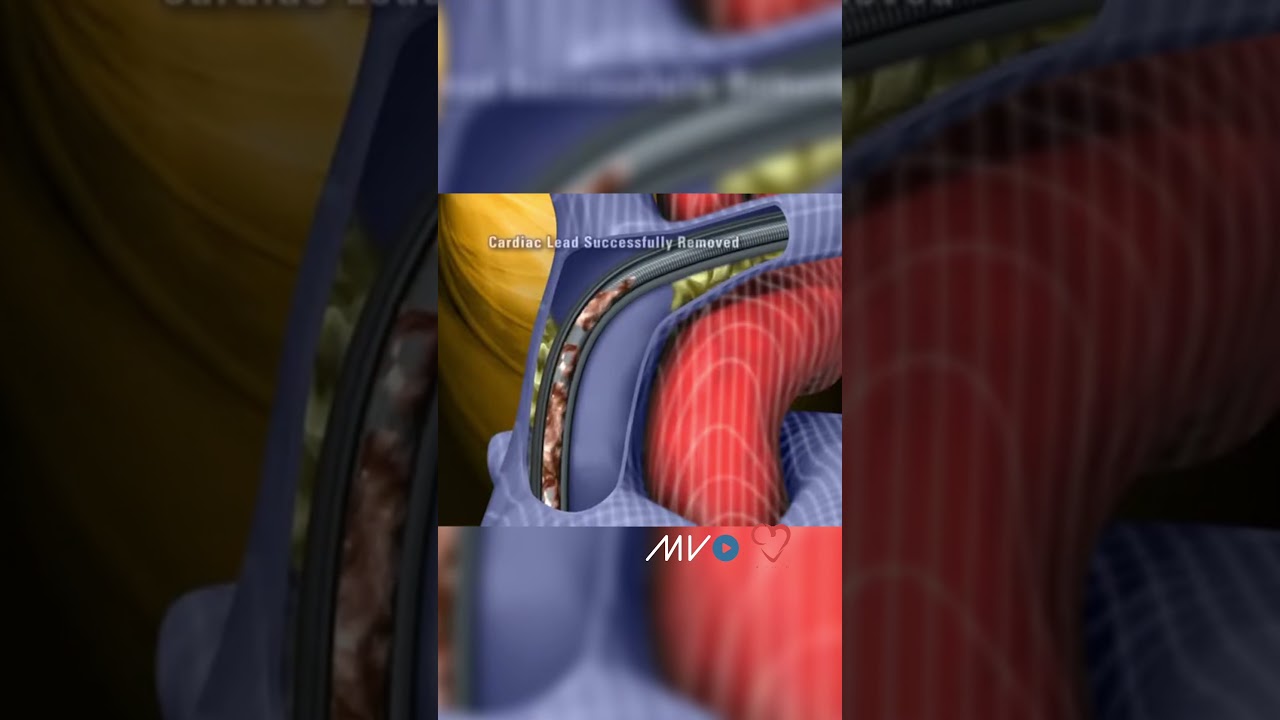 Removing Pacemaker Lead