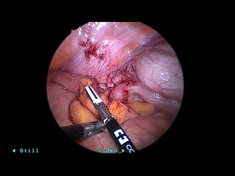 Laparoscopic appendectomy