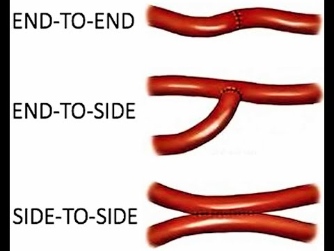 Internal Anastomosis CPT code - simplify medical coding