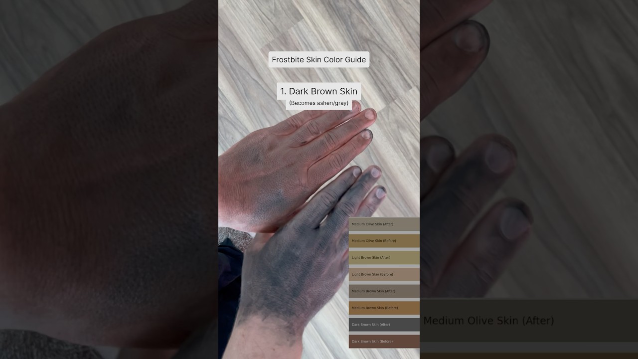 Frostbite Skin Color Guide