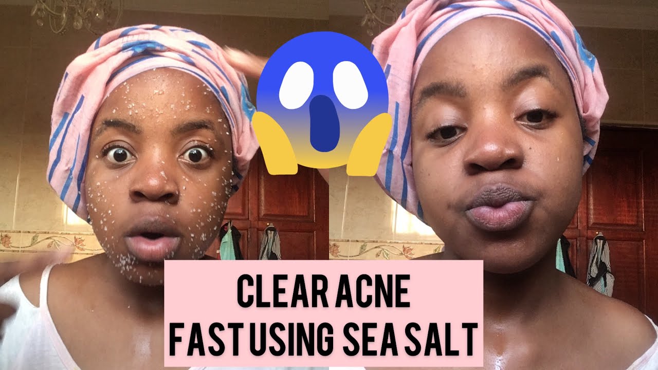 HOW TO CLEAR ACNE FAST USING SEA SALT 🧂||SKINCARE SECRETS|| Skin care tips✨