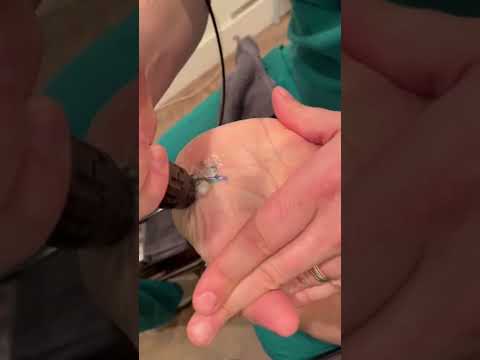 Carpal Tunnel Treatment for PERMANENT Relief Without Surgery