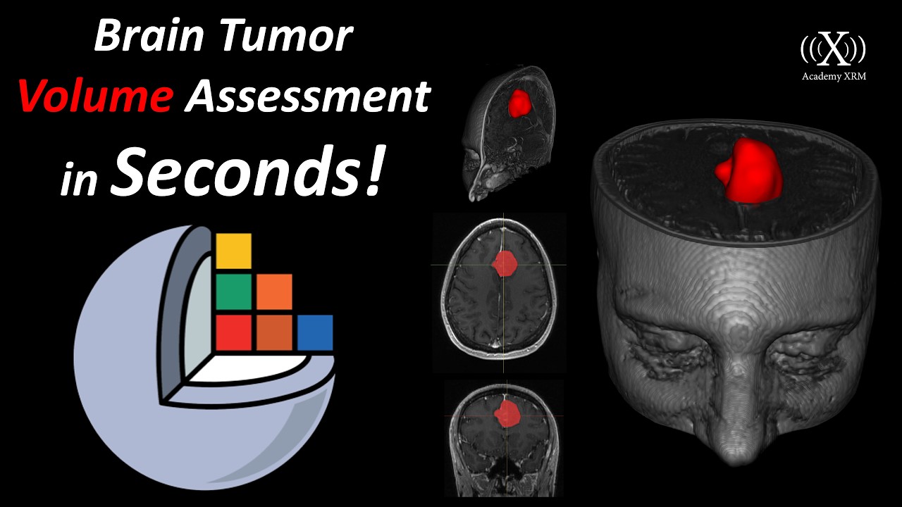 Brain Tumor Segmentation and Volume Assessment in 50 Seconds Using 3D Slicer