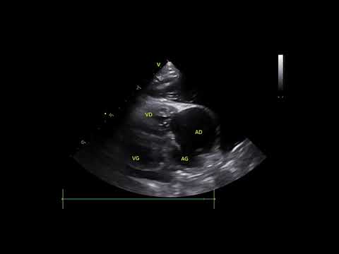 Eisenmenger's syndrome and an atrial septal defect in young ๐