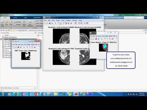 Brain Tumor Detection Quantification MRI DCIOM IMAGES
