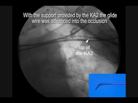 Catheter to provides support required to advace a wire through a total subclavian occlusion Audio le